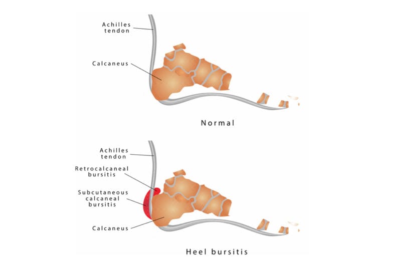 Bursitis of the Heel - What is it? - Ultrasound Guided Injections
