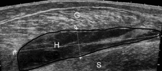 Tennis Leg Calf Muscle Tear Ultrasound Guided Injections