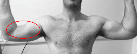 Distal biceps tendon injuries of the elbow - Ultrasound Guided Injections