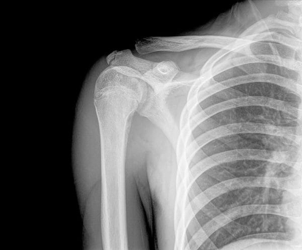 X Ray Shoulder Arthritis