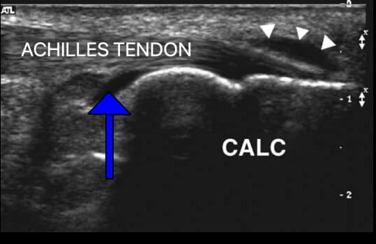 Retrocalcaneal Bursitis Ultrasound