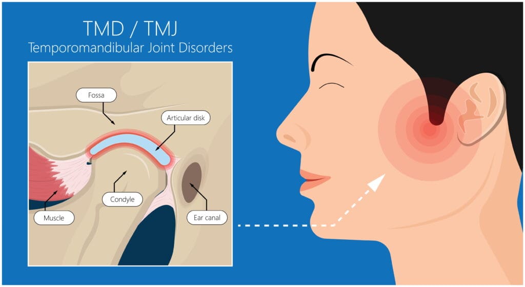 Expert TMJ Injection Therapy Ultrasound Guided Injections